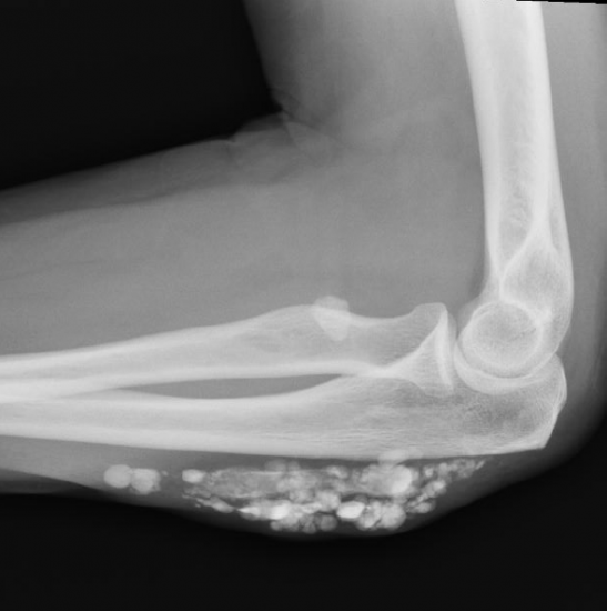 Calcification disorders in man